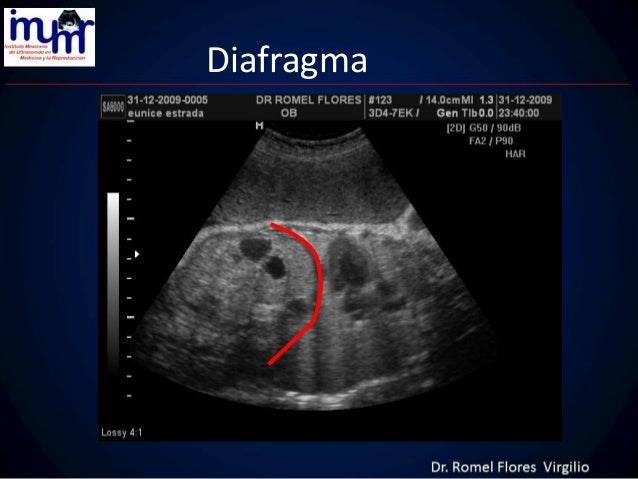 Evaluacion del torax fetal por ultrasonido. dr. romel flores