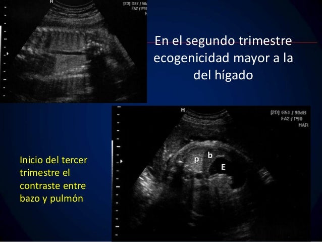 Evaluacion del torax fetal por ultrasonido. dr. romel flores