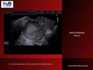 Evaluacion ultrasonografica de la gestacion antes de las 11 semanas | PDF