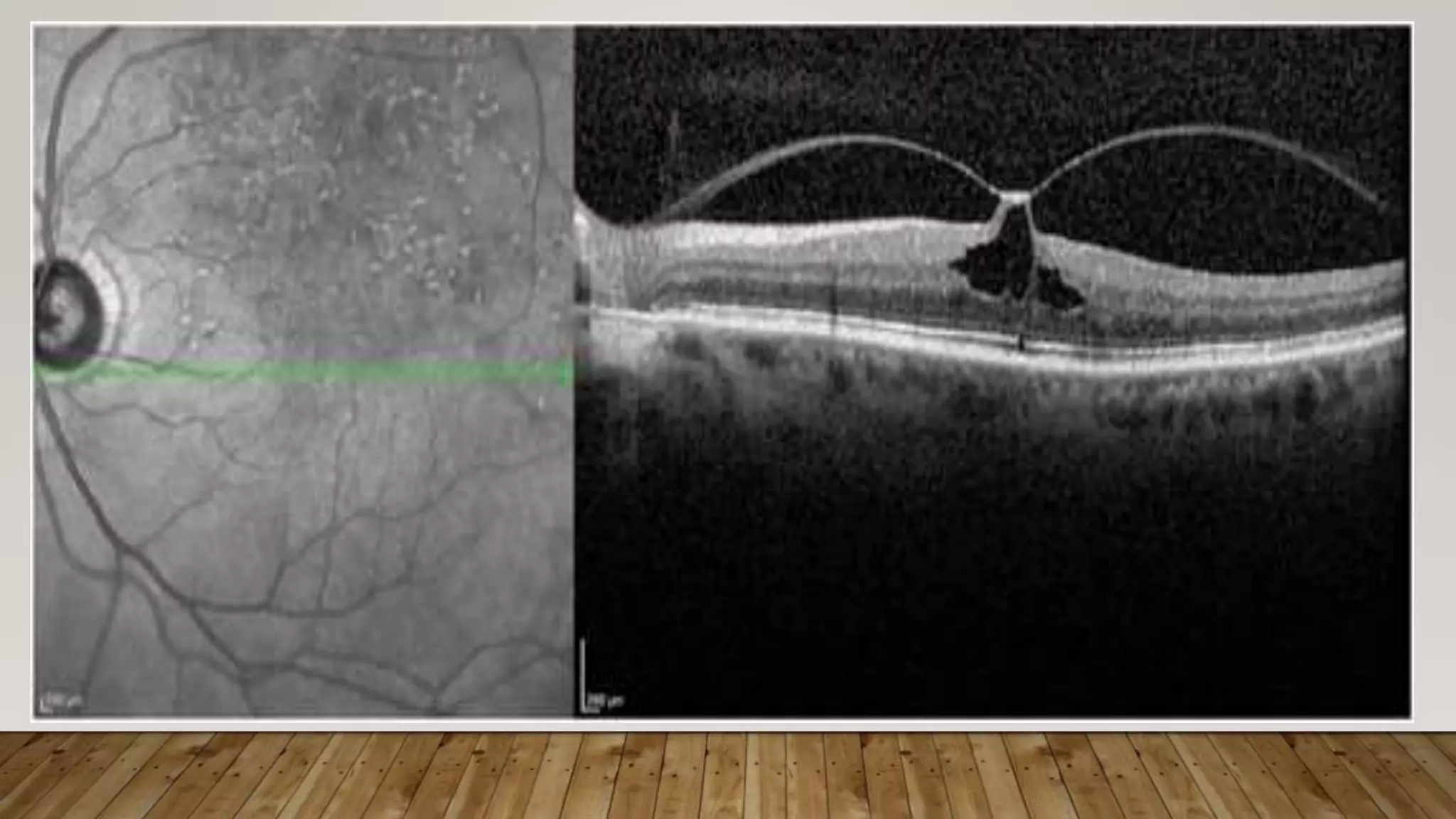 PRINCIPLES OF MANAGEMENT OF MACULAR HOLE | PPT