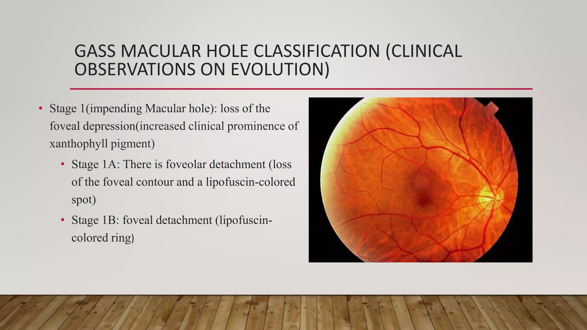 PRINCIPLES OF MANAGEMENT OF MACULAR HOLE | PPT