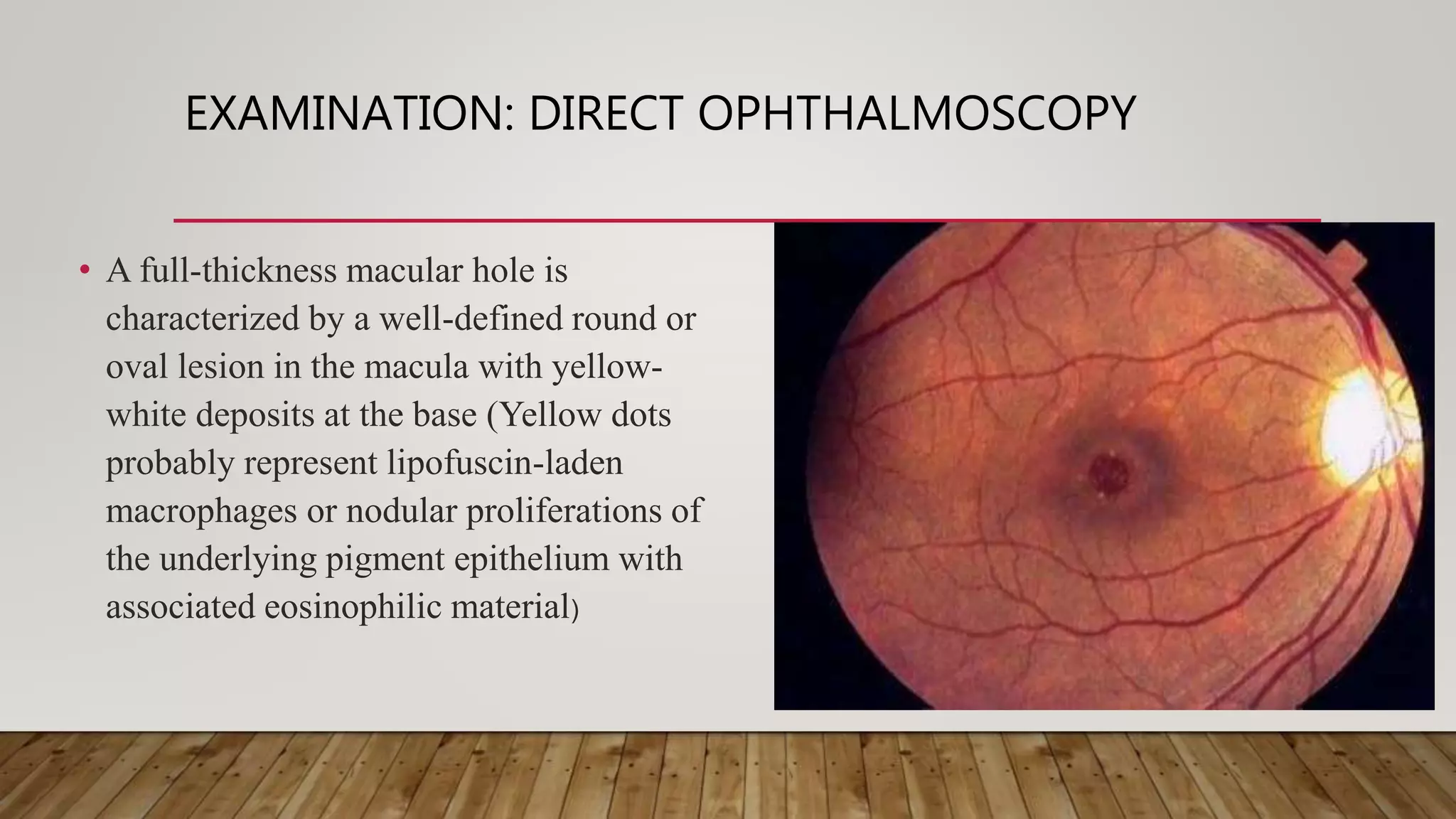 PRINCIPLES OF MANAGEMENT OF MACULAR HOLE | PPT
