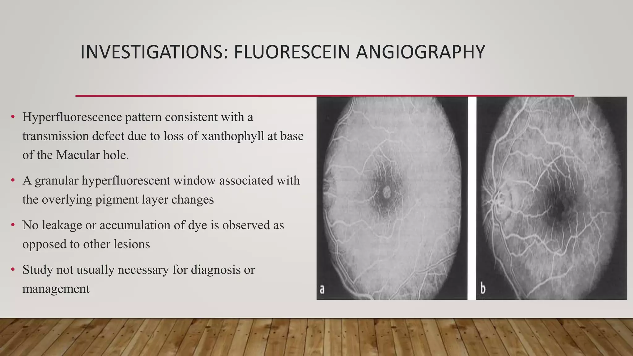 PRINCIPLES OF MANAGEMENT OF MACULAR HOLE | PPT