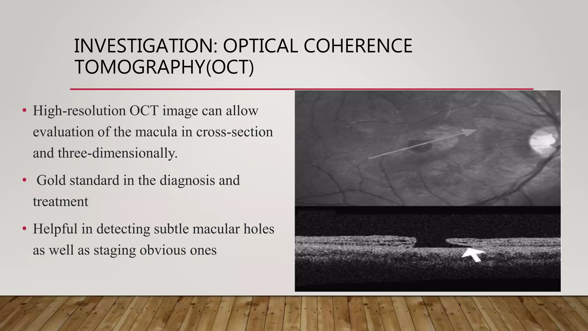 PRINCIPLES OF MANAGEMENT OF MACULAR HOLE | PPT