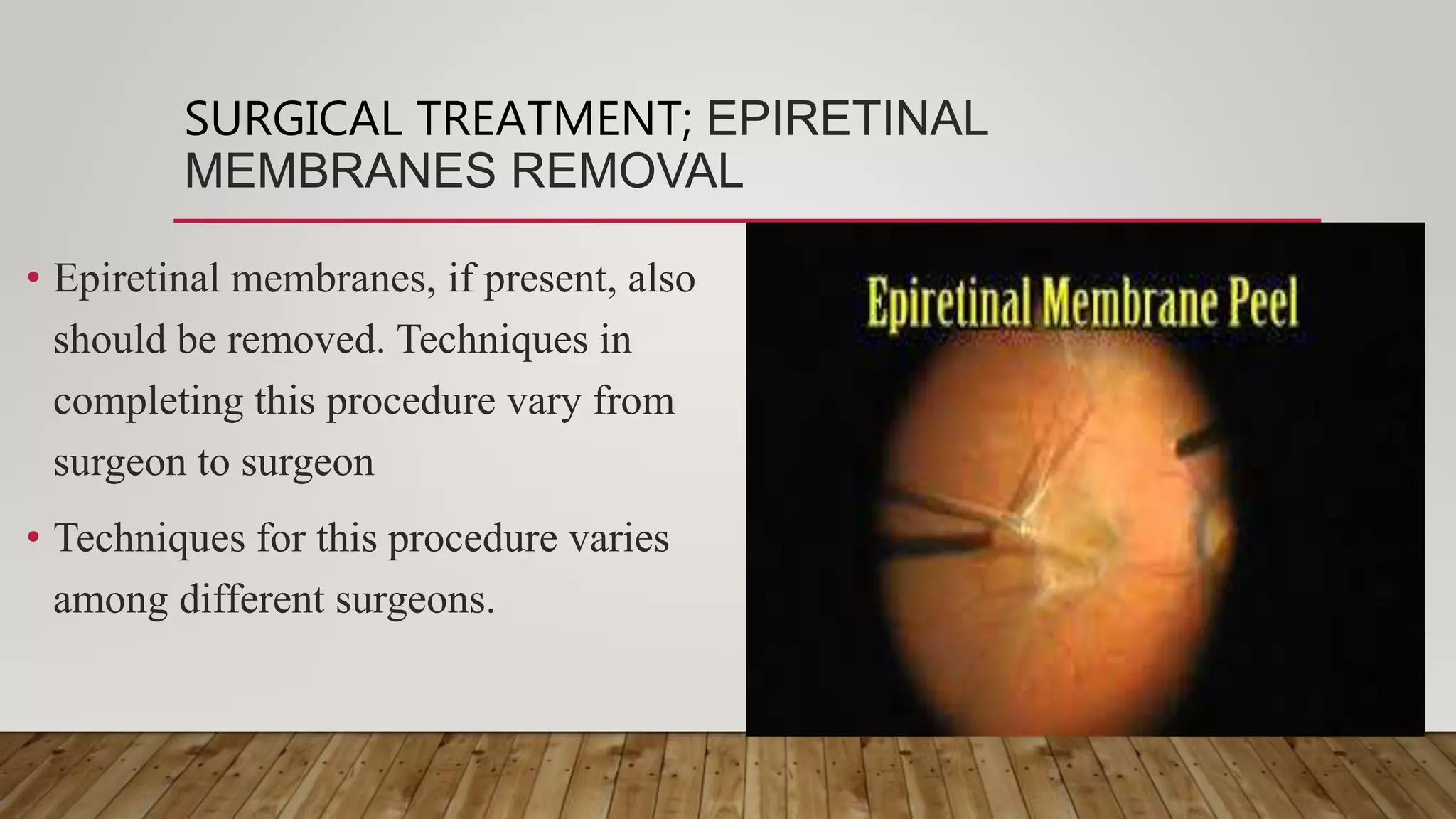 PRINCIPLES OF MANAGEMENT OF MACULAR HOLE | PPT