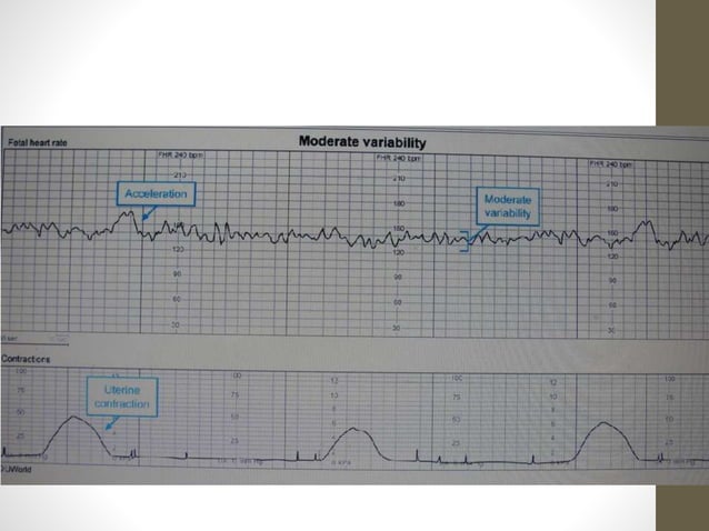 Evaluating of fetal heart tracing | PPTX