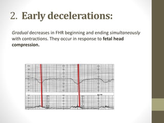 Evaluating of fetal heart tracing | PPTX