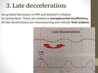 Evaluating of fetal heart tracing | PPTX