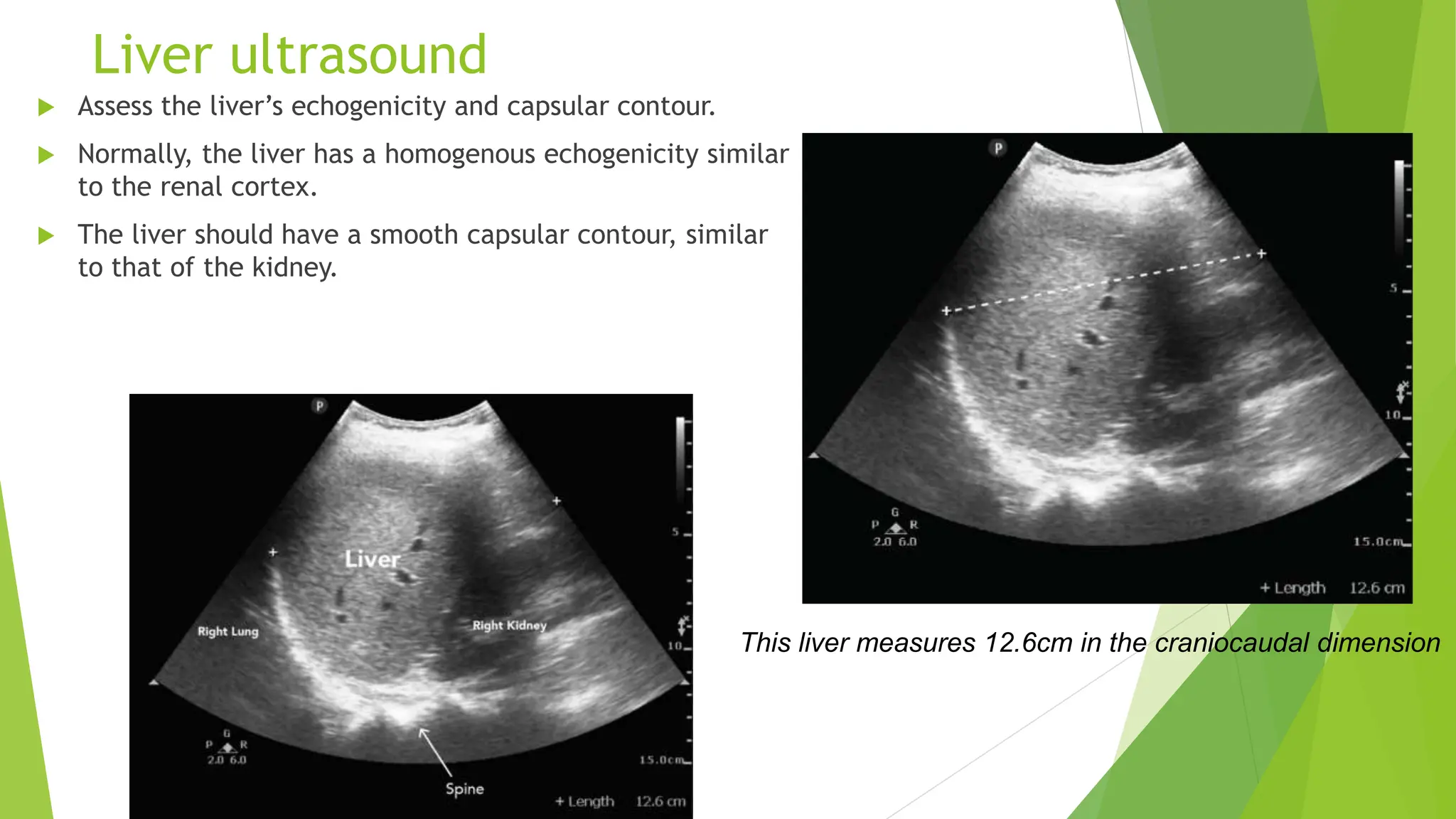 Evaluation abdominal Point of care ultrasonography (POCUS)is advanced ...