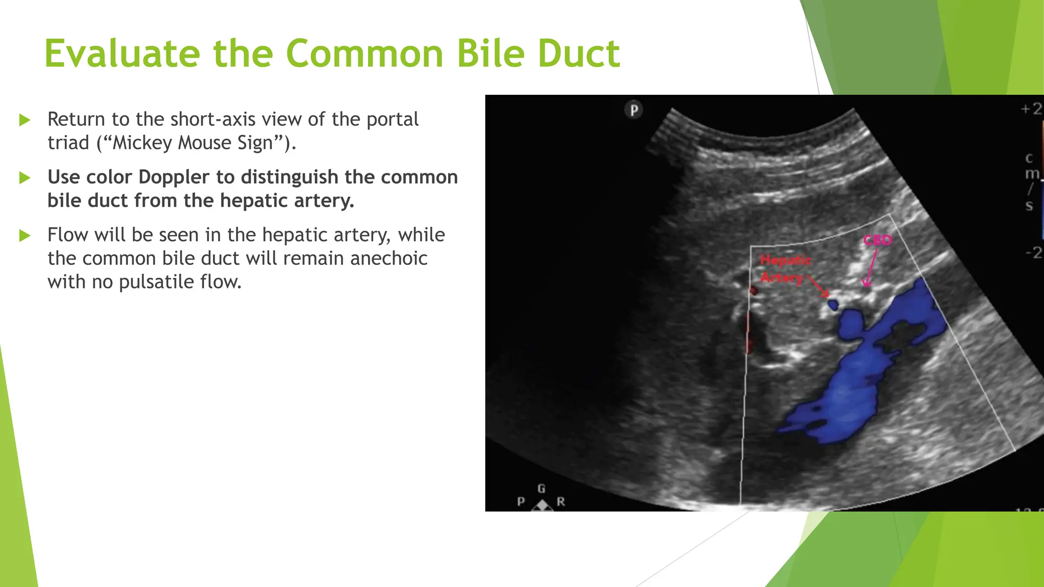 Evaluation abdominal Point of care ultrasonography (POCUS)is advanced ...