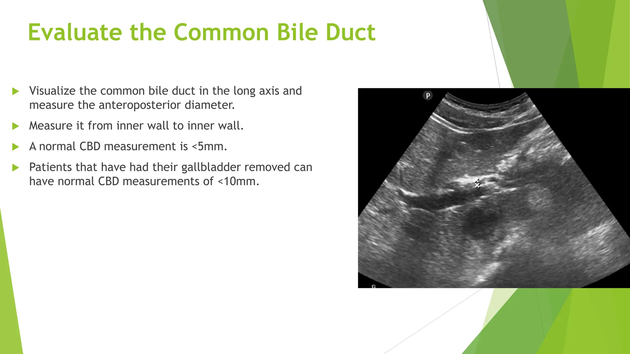 Evaluation abdominal Point of care ultrasonography (POCUS)is advanced ...