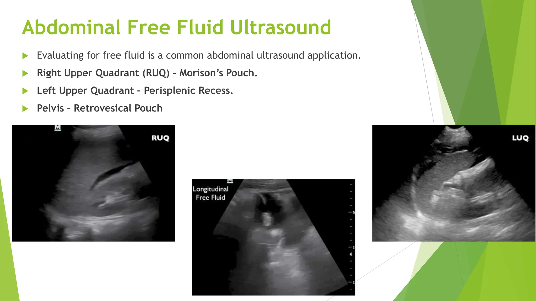 Evaluation abdominal Point of care ultrasonography (POCUS)is advanced ...