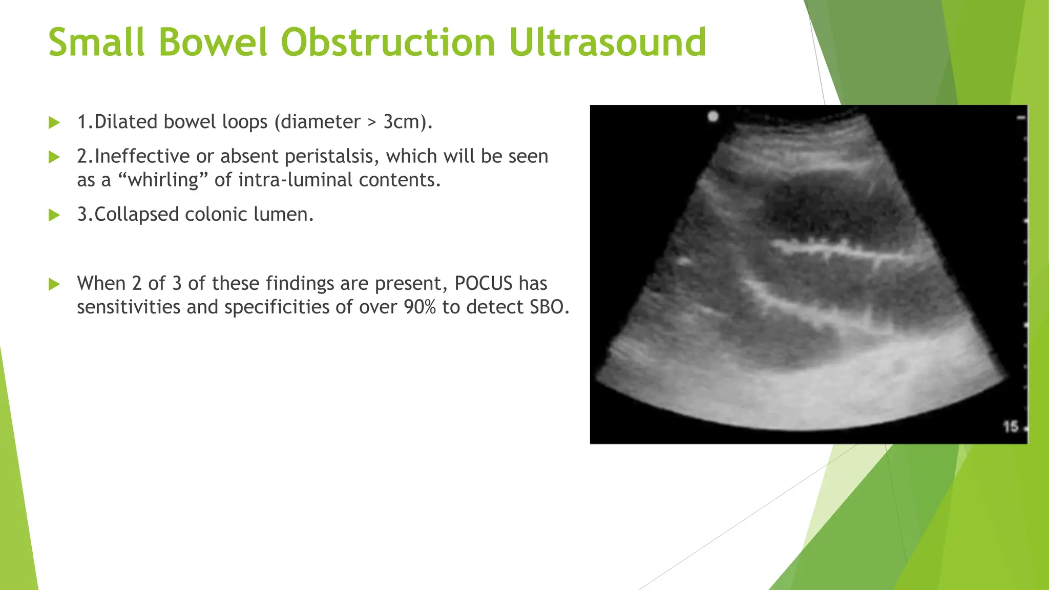 Evaluation abdominal Point of care ultrasonography (POCUS)is advanced ...