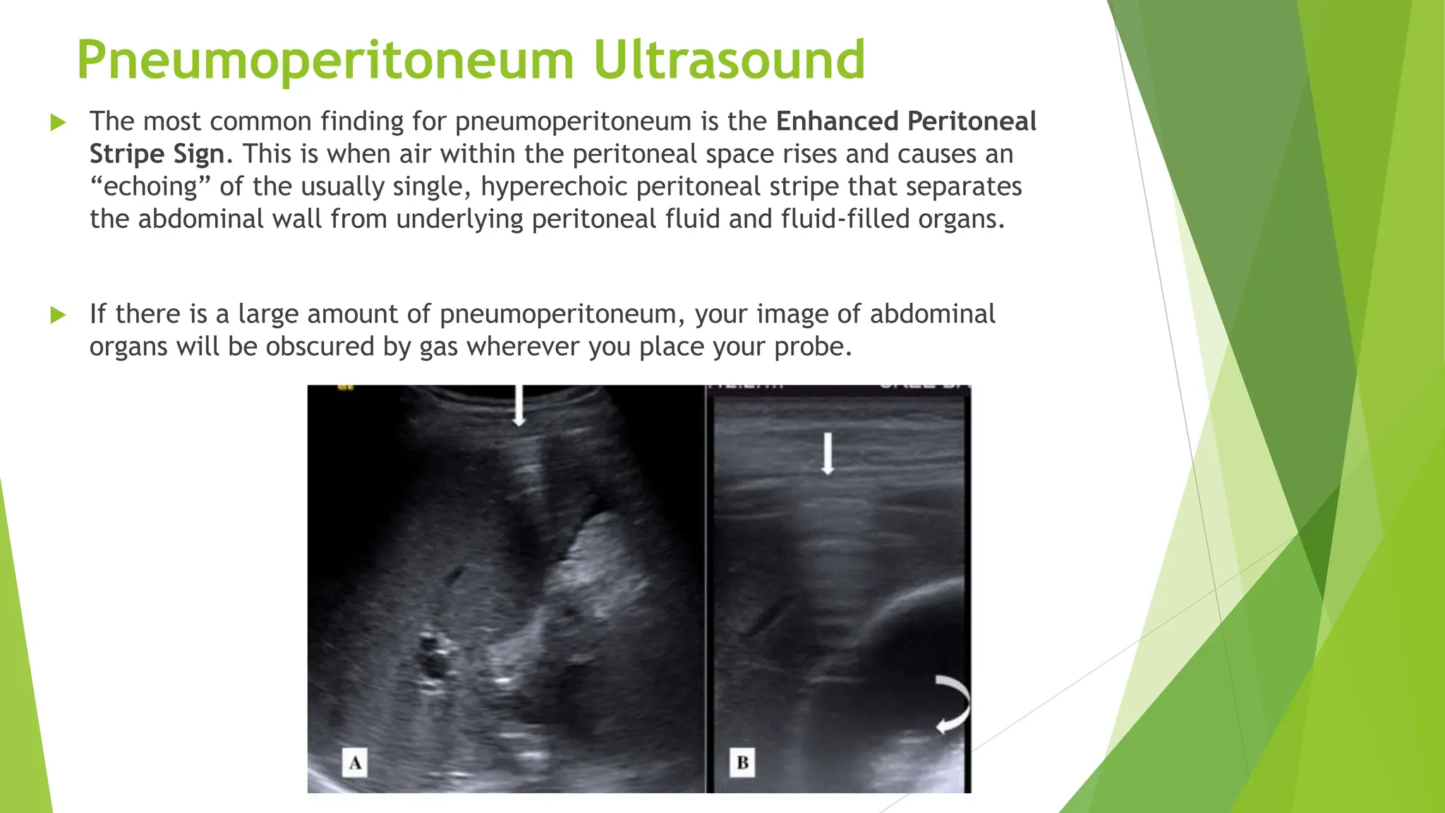 Evaluation abdominal Point of care ultrasonography (POCUS)is advanced ...