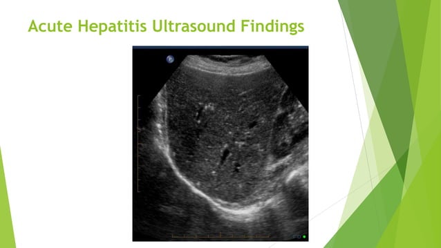 Evaluation abdominal Point of care ultrasonography (POCUS)is advanced ...