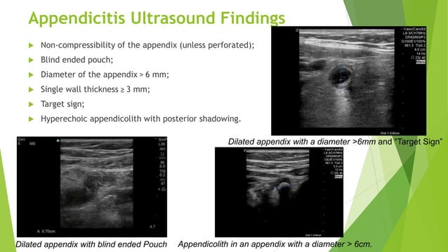 Evaluation abdominal Point of care ultrasonography (POCUS)is advanced ...