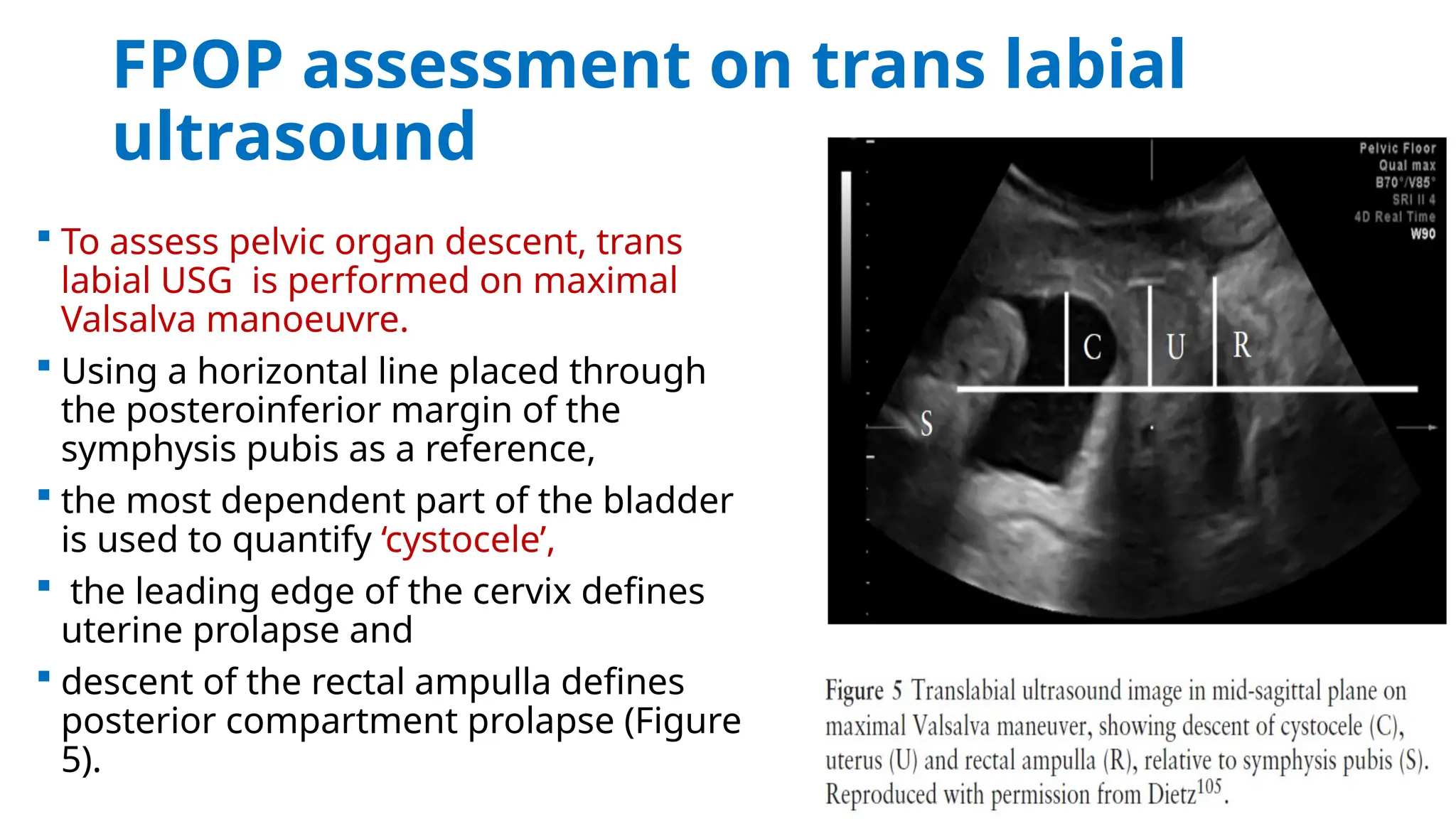Evaluation and Decision Making in Pelvic Organ Prolapse | Comprehensive ...