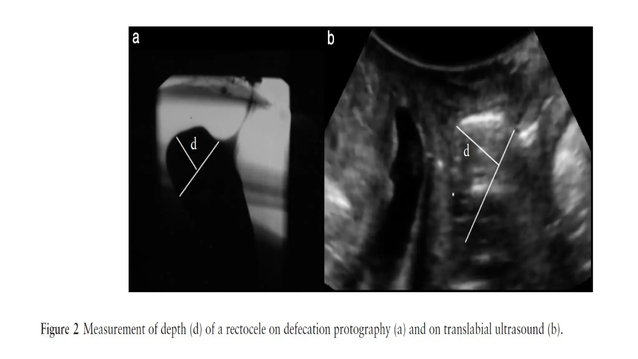 Evaluation and Decision Making in Pelvic Organ Prolapse | Comprehensive ...