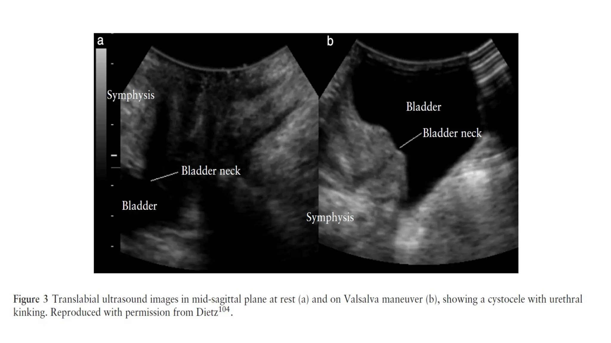 Evaluation and Decision Making in Pelvic Organ Prolapse | Comprehensive ...
