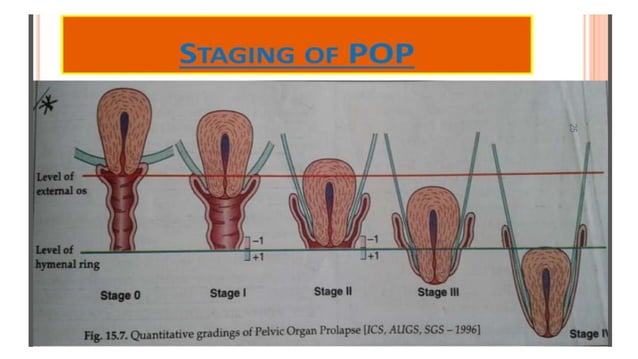 Evaluation and Decision Making in Pelvic Organ Prolapse | Comprehensive ...