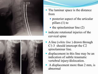Ligne Spino Laminaire: Radio Cervicale Normale – ALIS