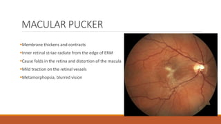 Evaluation and management of epiretinal membranes | PPTX