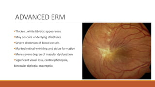 Evaluation and management of epiretinal membranes | PPTX