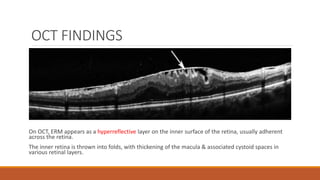 Evaluation and management of epiretinal membranes | PPTX