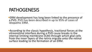 Evaluation and management of epiretinal membranes | PPTX