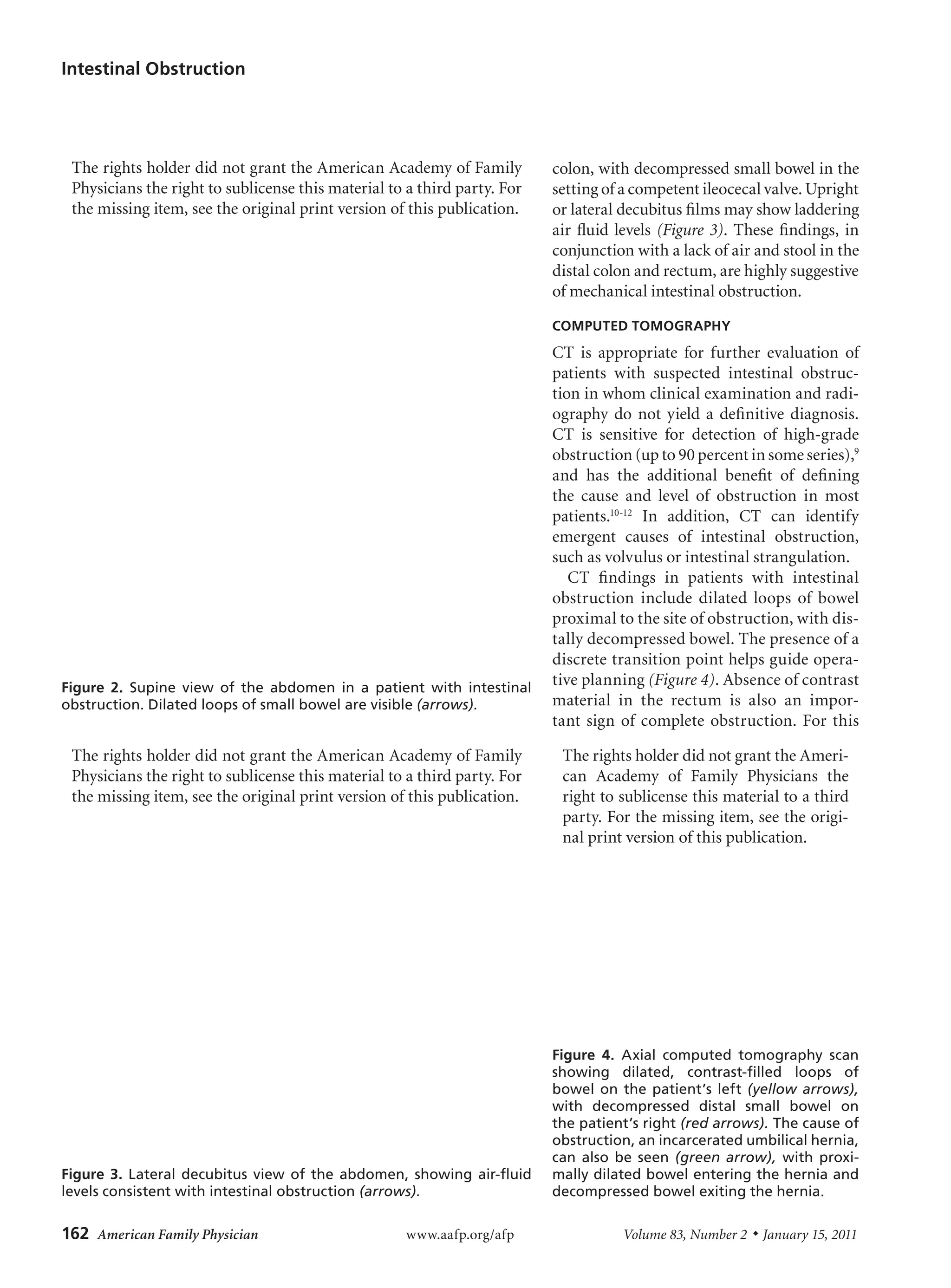 Evaluation and management of intestinal obstruction | PDF