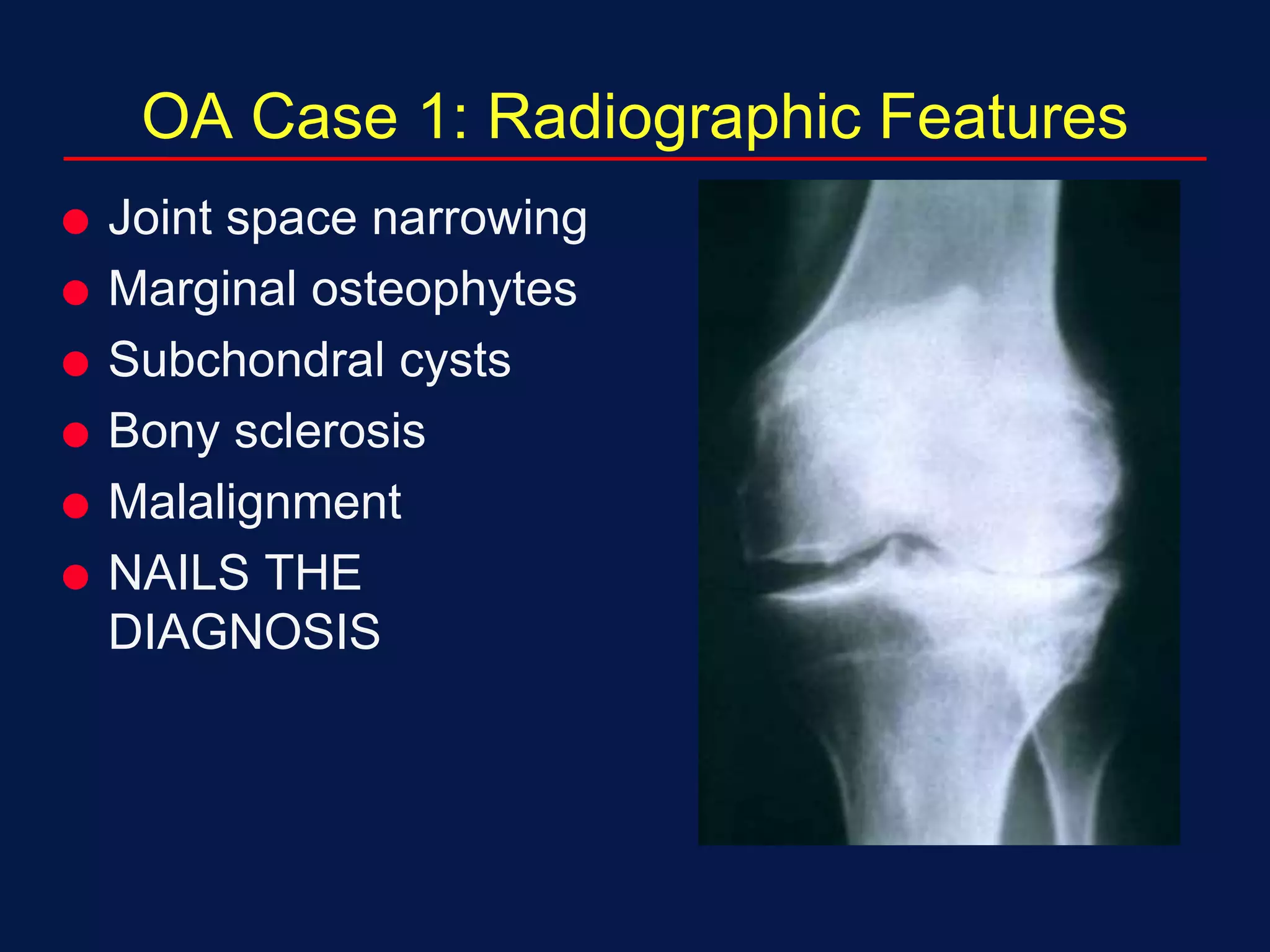 Evaluation And Management Of Osteoarthritis 2 Ppt