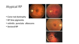 Comprehensive Management and Genetic Insights of Retinitis Pigmentosa ...