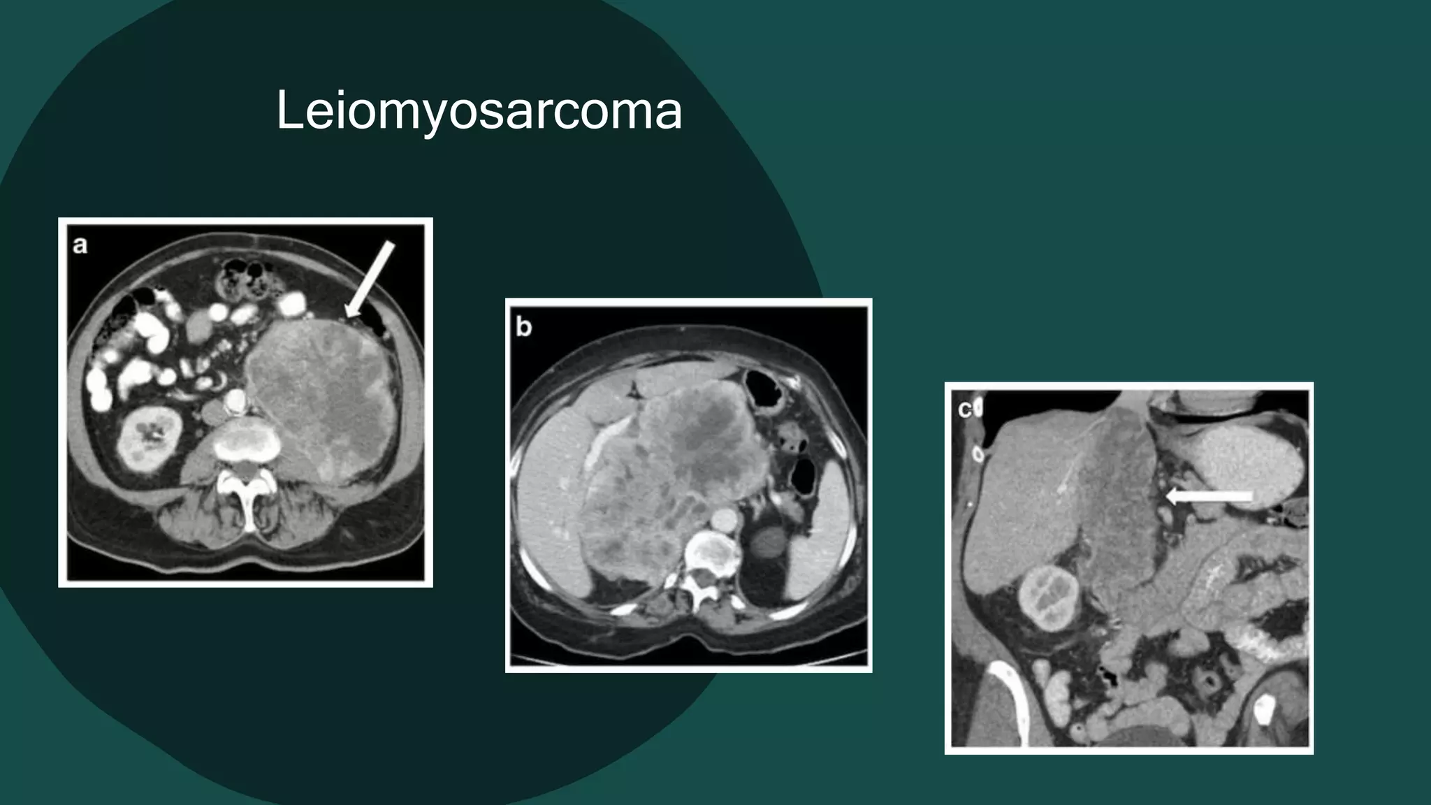Evaluation and Management of Retroperitoneal Sarcoma.pptx