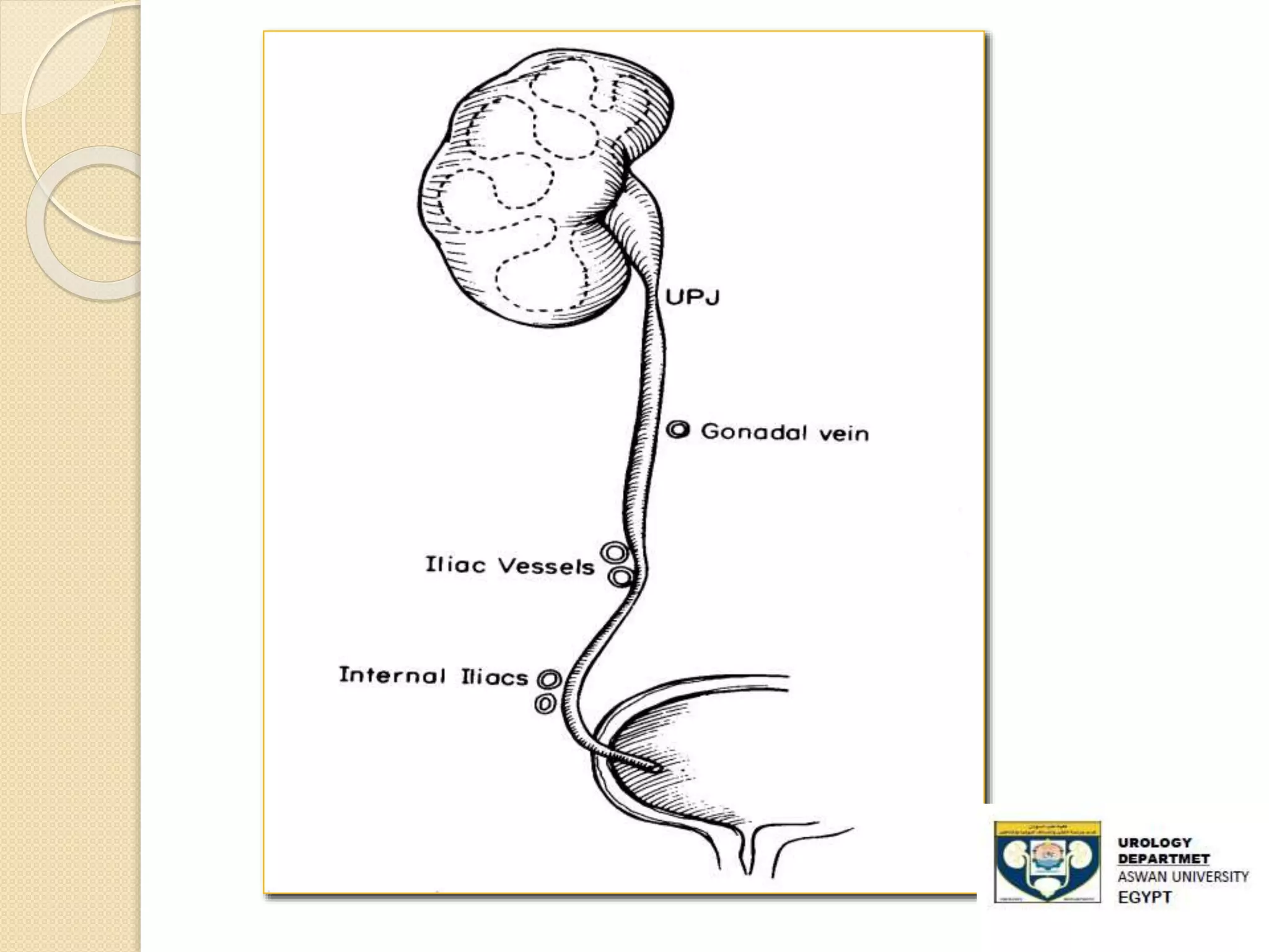 Evaluation and management of ureteric stones | PPTX