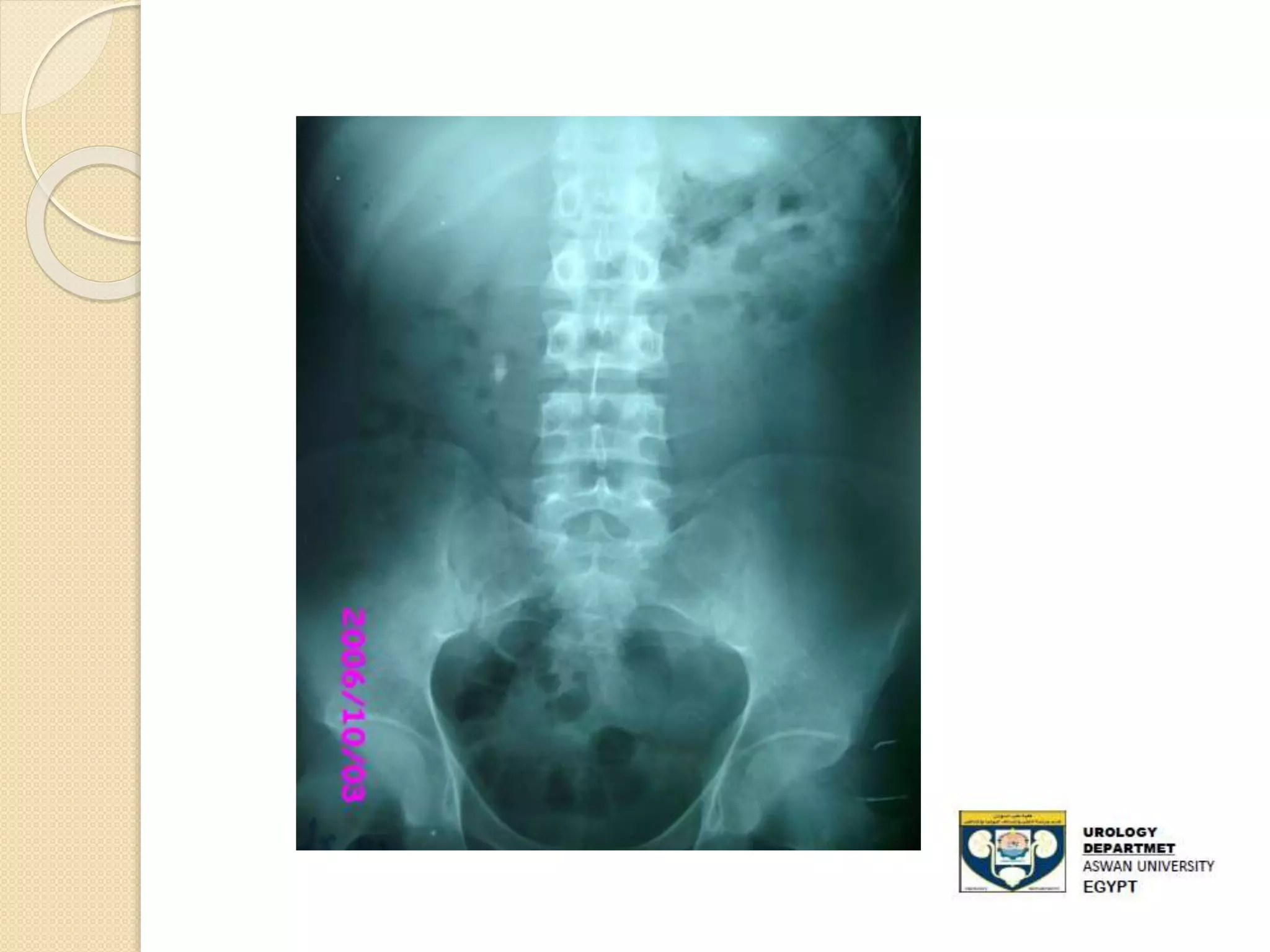 Evaluation and management of ureteric stones | PPTX