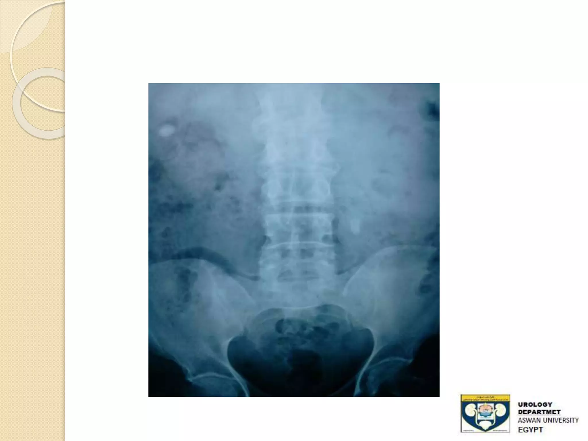 Evaluation and management of ureteric stones | PPTX