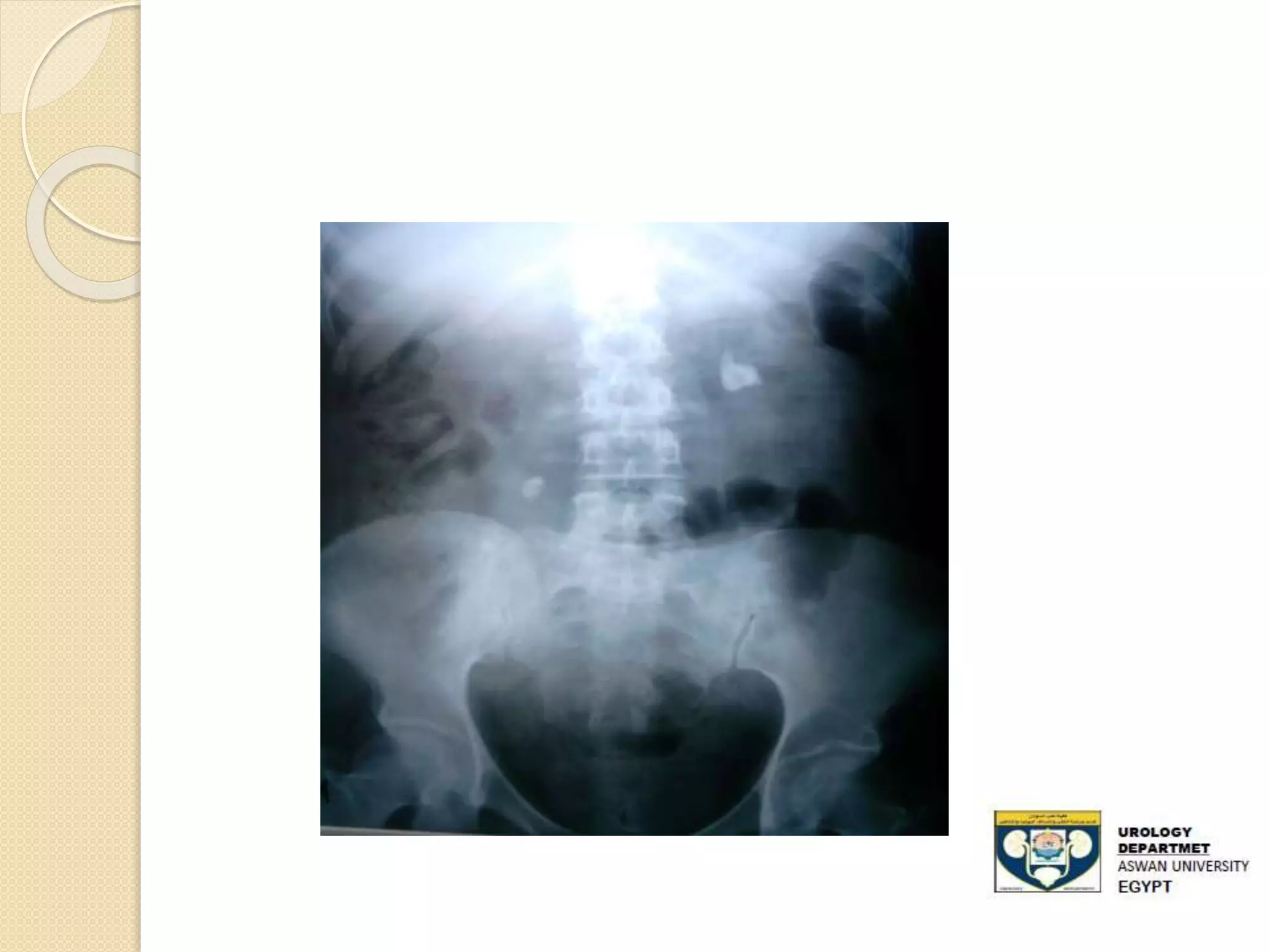 Evaluation and management of ureteric stones | PPTX