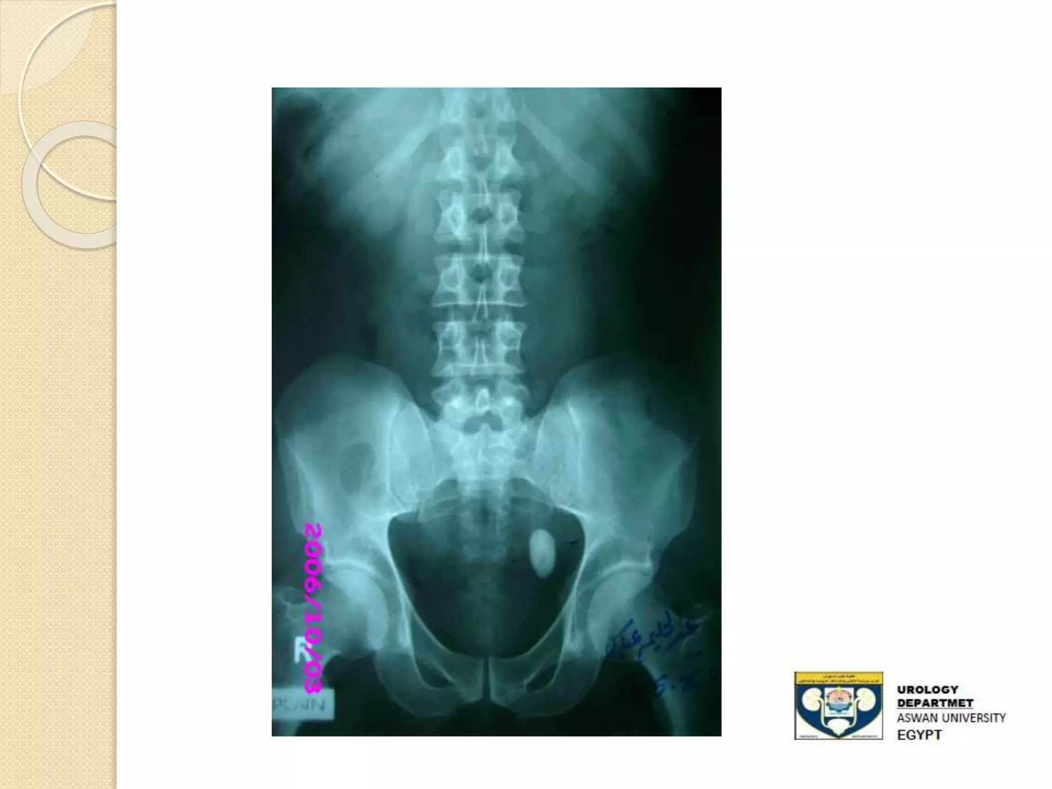 Evaluation and management of ureteric stones | PPTX