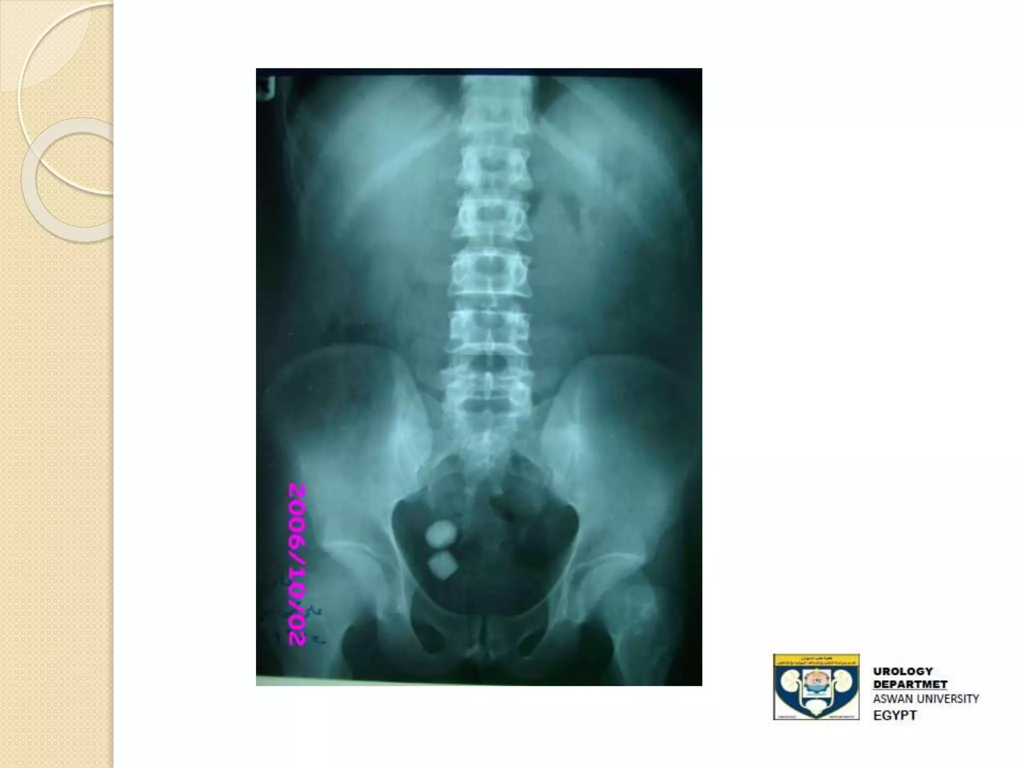 Evaluation and management of ureteric stones | PPTX