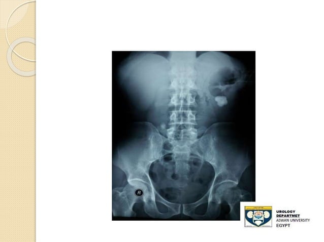 Evaluation and management of ureteric stones | PPTX | Digestive ...