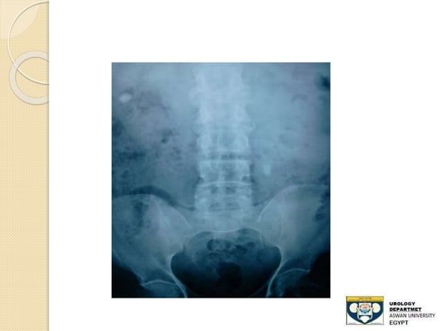 Evaluation and management of ureteric stones | PPTX | Digestive ...