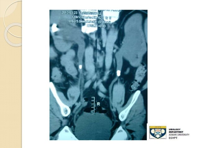 Evaluation and management of ureteric stones | PPTX | Digestive ...