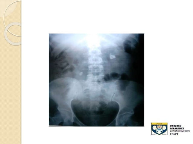 Evaluation and management of ureteric stones | PPTX | Digestive ...