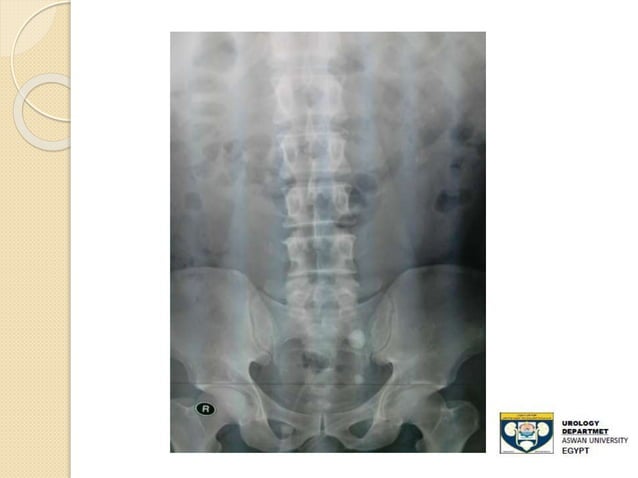 Evaluation and management of ureteric stones | PPTX | Digestive ...