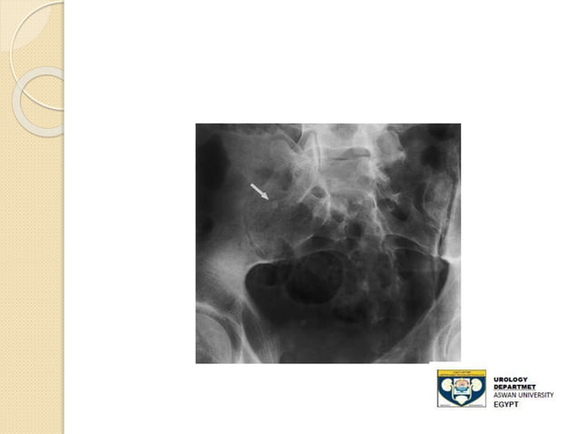 Evaluation and management of ureteric stones | PPTX | Digestive ...