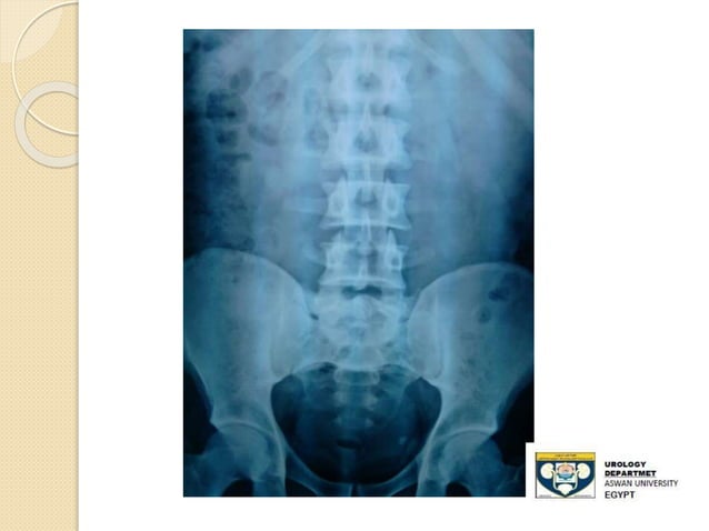 Evaluation and management of ureteric stones | PPTX | Digestive ...