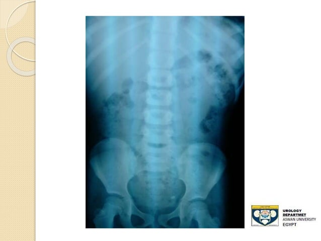 Evaluation and management of ureteric stones | PPTX | Digestive ...