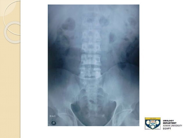 Evaluation and management of ureteric stones | PPTX | Digestive ...