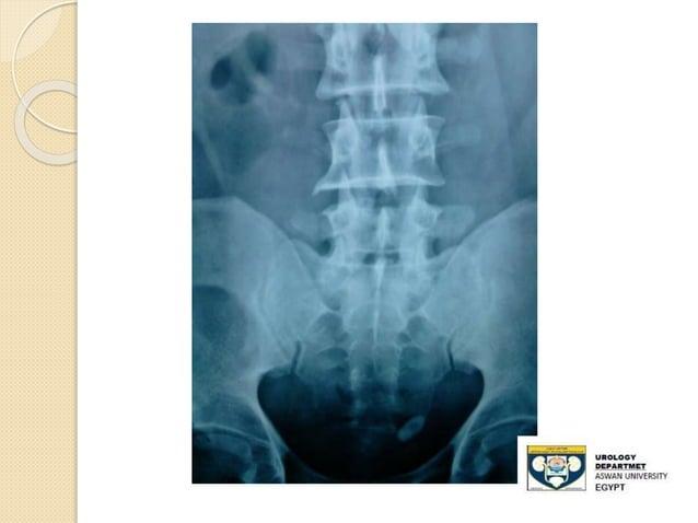 Evaluation and management of ureteric stones | PPTX | Digestive ...