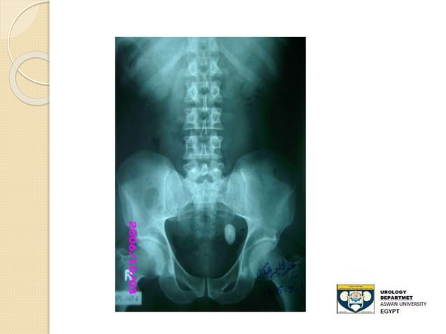 Evaluation and management of ureteric stones | PPTX | Digestive ...